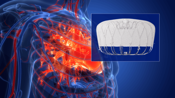 Baptist Health-Fort Smith Now Offers AFib Patients Procedure for Stroke ...